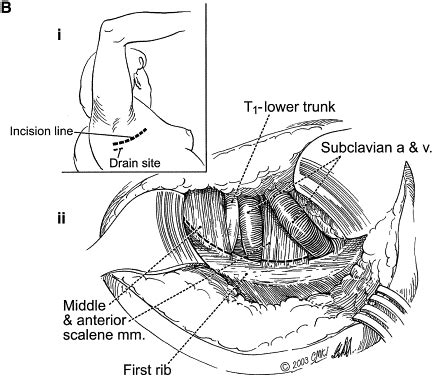 Combined Surgical Treatment Of Thoracic Outlet Syndrome Transaxillary