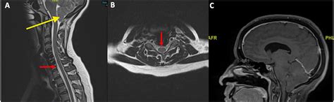 Delayed Cerebrospinal Fluid Csf Leak Following Anterior Cervical