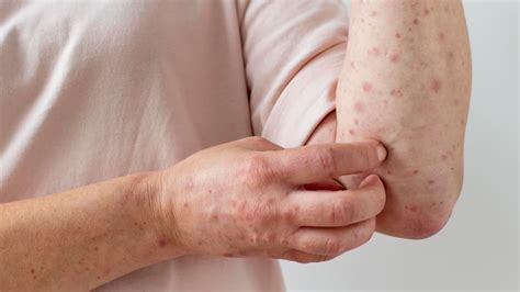 Clade 9 New Variant Of Chickenpox Virus Detected In India Know Symptoms And Prevention Tips
