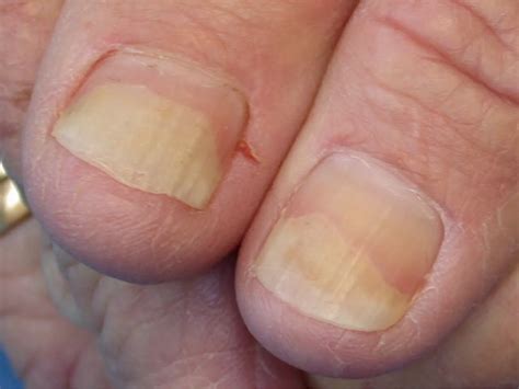 Common Types Of Nail Disease Pictures Symptoms Treatment