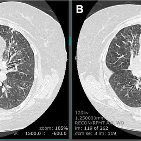 Chest Computed Tomography Ct Scan Showing Multiple Pulmonary Nodules Download Scientific