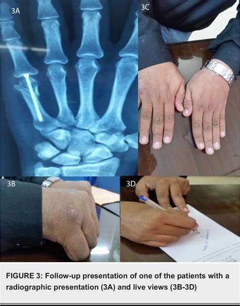 Figure 3 From Fixation Of Metacarpal Fractures Using Intramedullary Headless Compression Screws