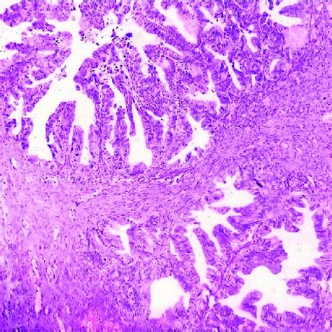 Microscopic Examination Shows Complex Papillary Architecture With Download Scientific Diagram