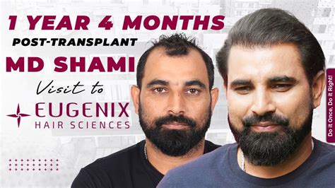From Cricketer To Hair Icon Mohd Shamis Hair Transplant Success Story At 1 Year 4 Months Youtube