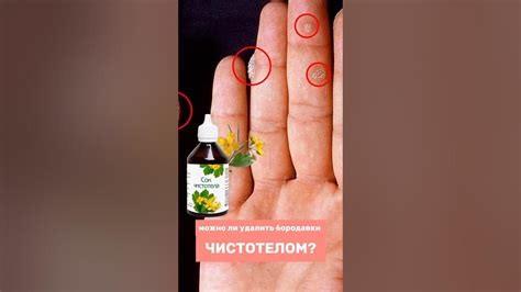 Бородавки и папилломы удаление чистотелом Это ОПАСНО Youtube
