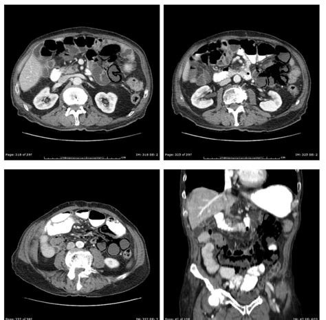 Abdominal Ct Shows Dilatation Of Small Bowel Loops And The Air Bubbles Download Scientific