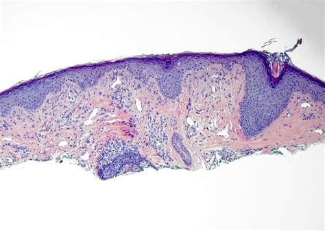 Histologia Do Angiofibroma Juvenile Angiofibroma Histology And