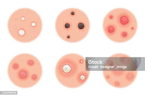 Understanding Type Of Acne A Comprehensive Visual Guide For Everyone Stock Illustration