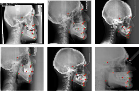Figure 3 From A Novel Cephalometric Tool Enhanced By Ai Assistance Short Paper Semantic Scholar