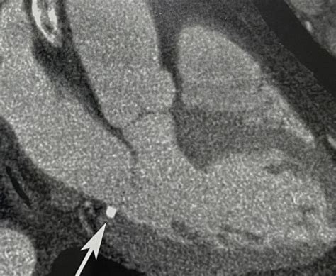 Anurag Singh On Linkedin Mitral Annular Calcification Three Chamber View Demonstrates…