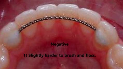 Bonded Retainer YouTube