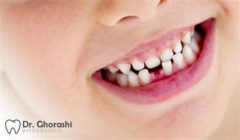 آیا کشیدن دندان آسیاب شیری کودکان کار درستی است؟