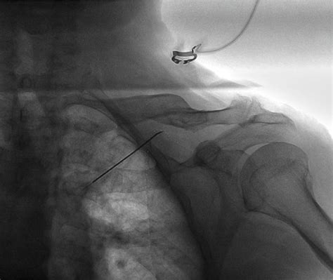 Tendon Injections Anesthesia Key