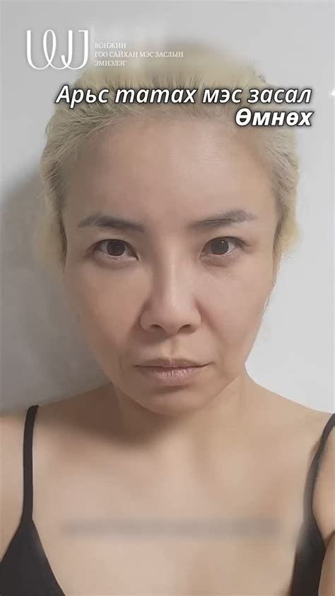 📌Залуужуулах нүүрний арьс татах мэс заслын мэргэшсэн эмч 📌 Солонгосын