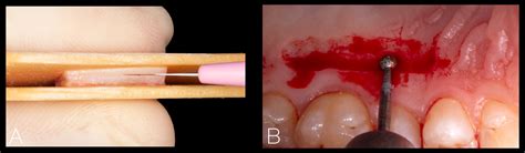 Autogenous Connective Tissue Grafts Biological And Technical Considerations Lefildentaire