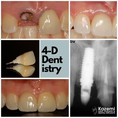 Implants For Front Teeth Smile Zone Implants For Front Teeth