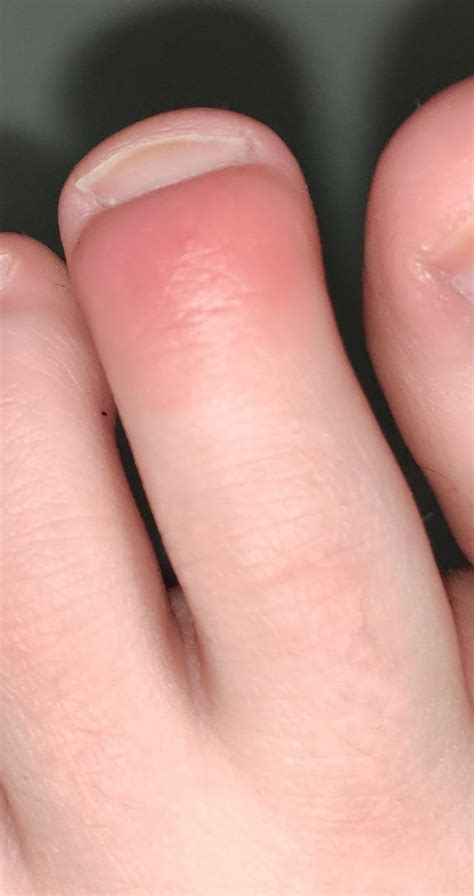 Redness On Toes R Dermatology