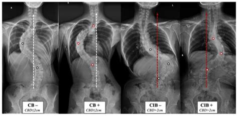 Apical Vertebras Distribution Modifier For Coronal Balance