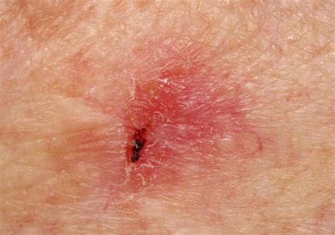 How Serious Is Superficial Basal Cell Carcinoma