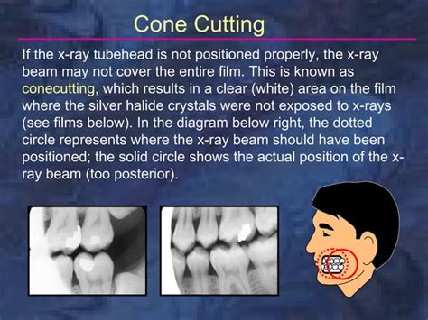 Radiology Bitewing Technique Ppt