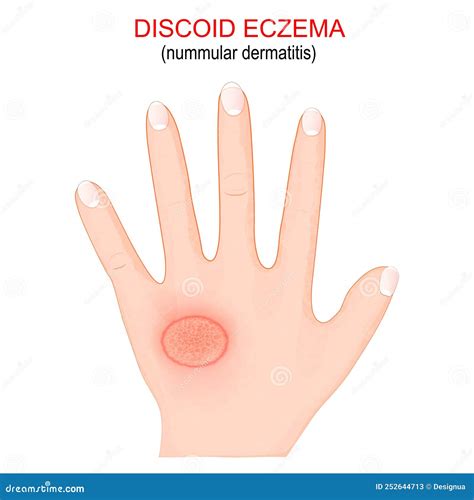 Nummular Dermatitis Discoid Eczema Cartoon Vector