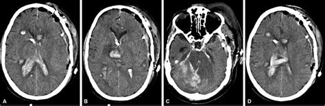 Axial Computed Tomography Ct Scan Illustrating The Presence Of