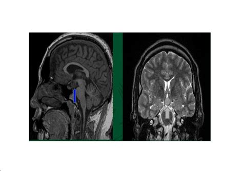 Hypothalamic Hamartoma Asagittal T1 Weighted Image Showing A Large