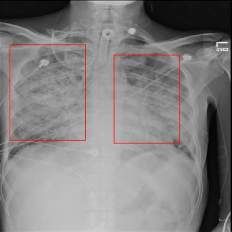Pneumonia Detection From Chest Radiograph Cxr · Intelec Ai Blog