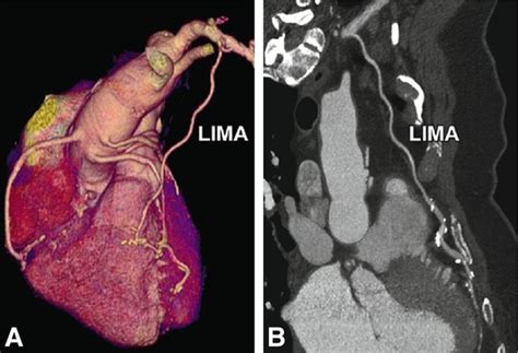 Lima Artery Anatomy