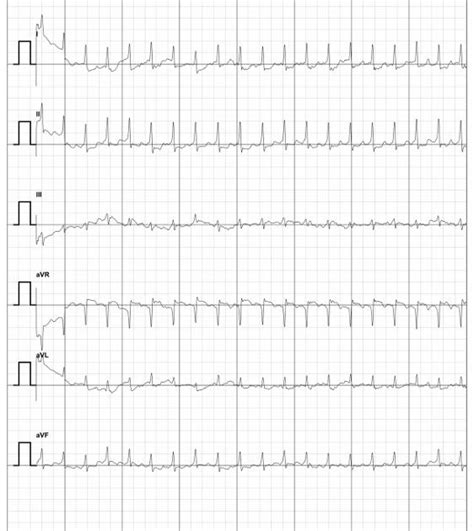 Svt Or Atrial Flutter I Was Diagnosed Atrial Fibrillati