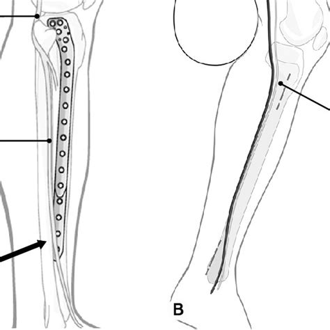 Pdf Proximal Tibia Fracture Plating
