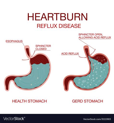 Heartburn Stomach Diseaseindigestion And Stomach Vector Image