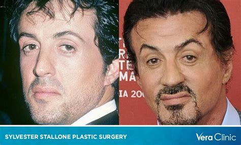 Sylvester Stallone Plastic Surgeries Before And After