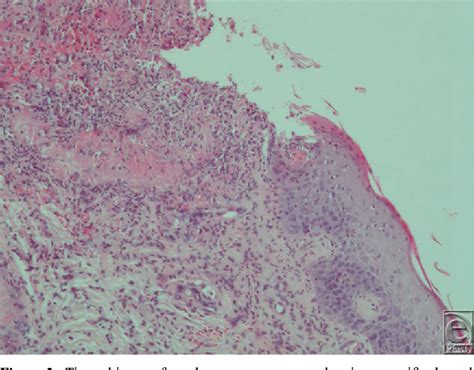 Figure 2 From Skin Grafting In Pyoderma Gangrenosum Semantic Scholar