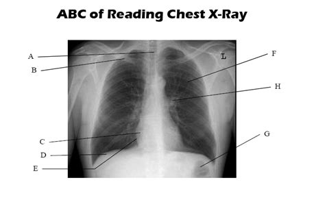 Chest X Ray Reading Abcde At Anthony Blubaugh Blog