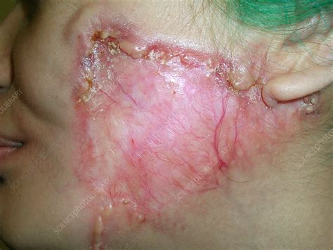 Pyoderma Gangrenosum Treated With Infliximab Stock Image C056 2648 Science Photo Library
