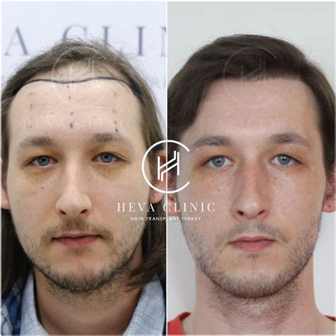 Tristan Tate Hair Transplant Hair Loss And Technical Analysis