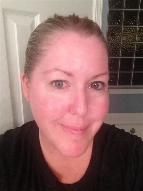 My Journey Through Topical Chemotherapy Fluorouracil 5 Cream And