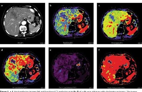 Figure 1 From Perfusion Ct Imaging Of The Liver Review Of Clinical Applications Semantic Scholar