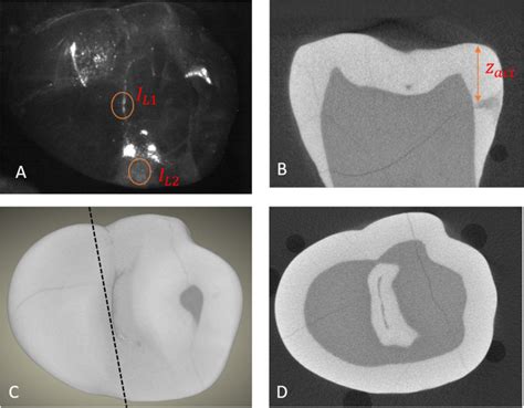 Estimating The Depth From The Occlusal Surface Of An Interproximal