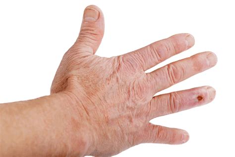 Skin Lesion Excision Skin Cancer Sa