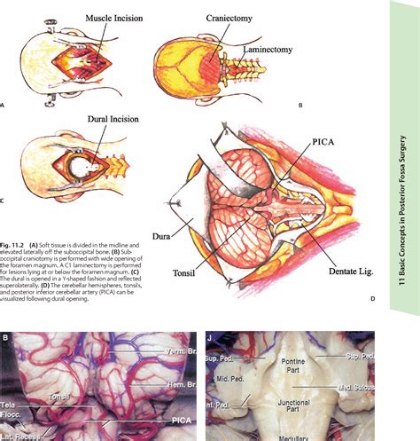 Posterior Fossa Craniotomy