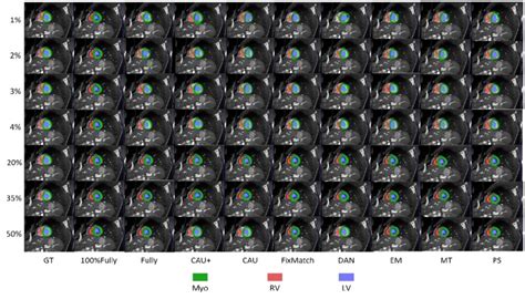 Comparison Of The Segmentation Effect On Acdc Download Scientific