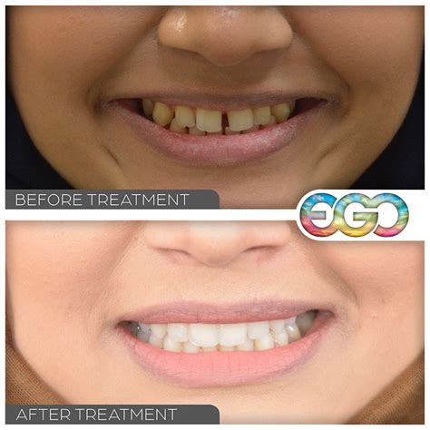 Invisalign Treatment EGO Dental Clinic Westminster London