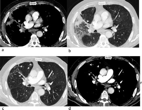 Parenchymal Opacities Associated With Pulmonary Embolism Respiratory