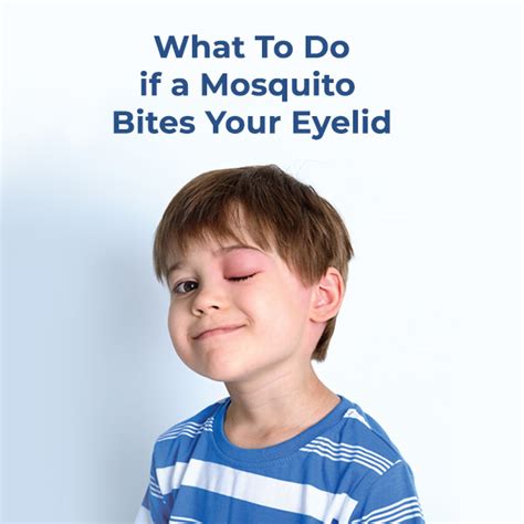 What To Do If A Mosquito Bites Your Eyelid Eyecarepro