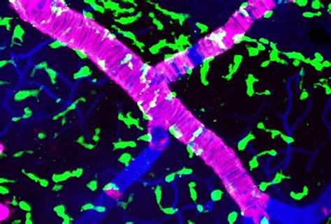 New Culprit In Amyloid Beta Accumulation And Neurodegeneration