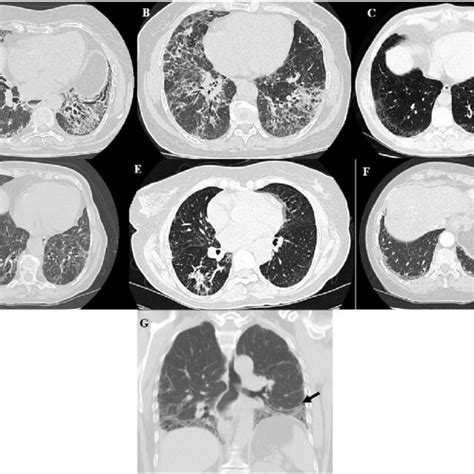 Radiological Features Of Ipaf Patients A Fibrotic Non Specific