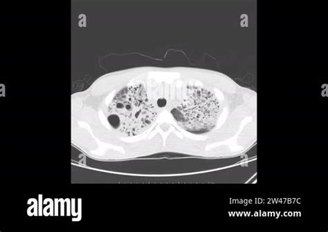 Axial Computed Tomography Of The Chest Lung Window In A Known Patient