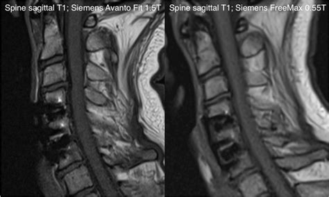 Exemplary Comparison Of A Sagittal T1 Sequence In The Context Of
